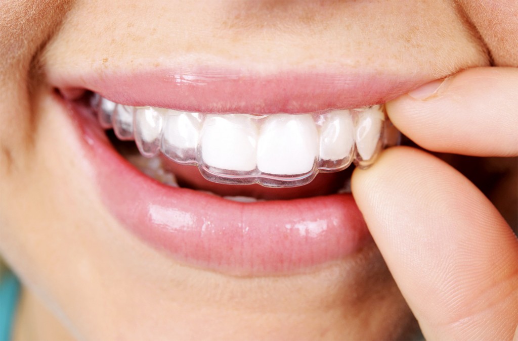 The Invisalign Process & Aligner Care