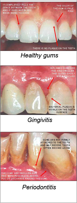 Treating Your Periodontal Disease