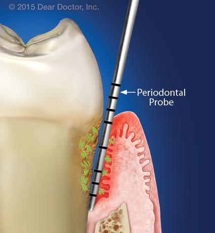 The Importance of Periodontal Probing and Charting