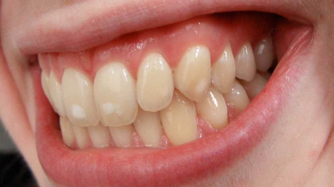 white-spots-teeth-dental-fluorsis-calcification